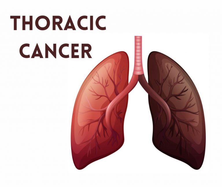 Thoracic Cancer treatment in Pune | Dr. Ashish Pokharkar
